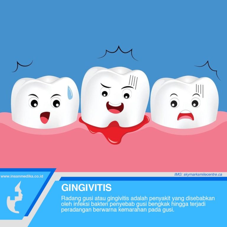 Cara Meredakan Sakit Gigi Menggunakan Obat Paling Mujarab Berikut Ini